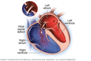 O que é aneurisma de septo interatrial? Entenda como acontece