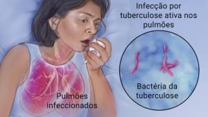Como Colher Escarro Para Exame De Tuberculose Passo A Passo