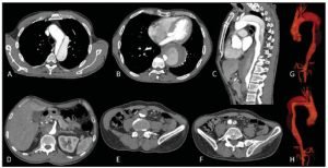 Exame de angiotomografia de tórax: do preparo ao procedimento